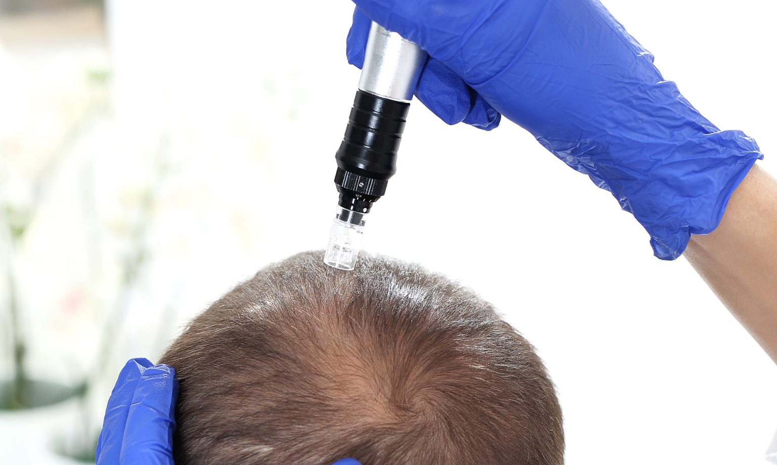 Hair Microneedling | Hair Growth Stimulation For Hair Loss